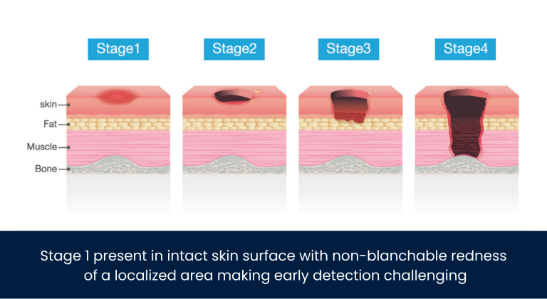Pressure Injury - IR MEDICAL
